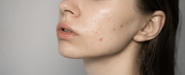 Blemishes and Spots – My Blog