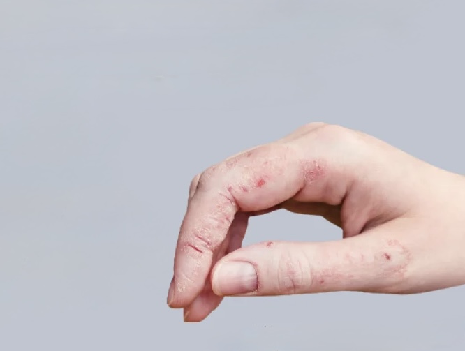 Fungal Infections! – Pradhanclinic