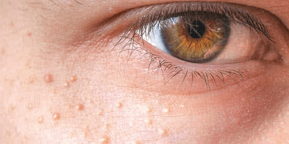 Milia Removal Treatment in Delhi NCR | Pradhan Clinic