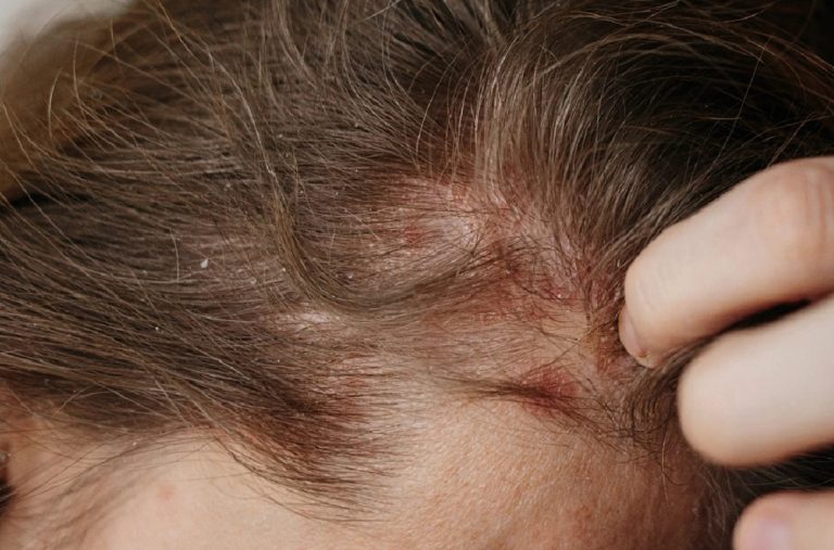 Understanding the condition Scalp Dermatitis ! - Pradhanclinic