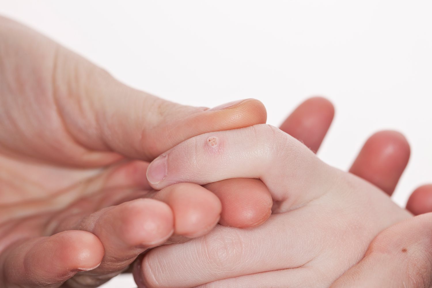 Skin Warts ! – Pradhanclinic